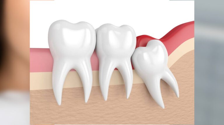 What Should You Do About a Wisdom Tooth Cavity? | Focus Dental