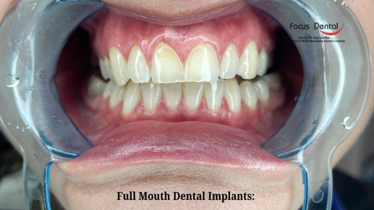 Full Mouth Dental Implants: Malo Titanium Bridge With Zirconia Crowns ...