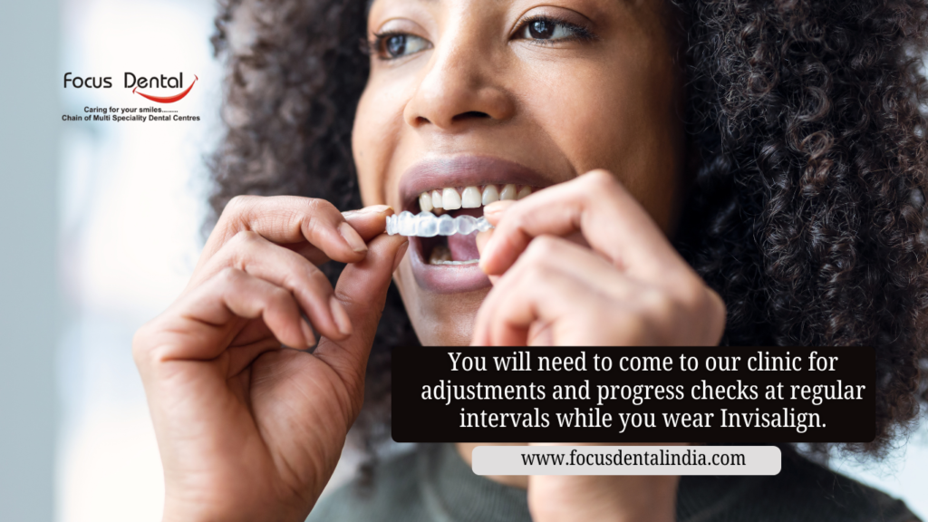 Comprehensive Guide To Invisalign Treatment In India - Focus Dental