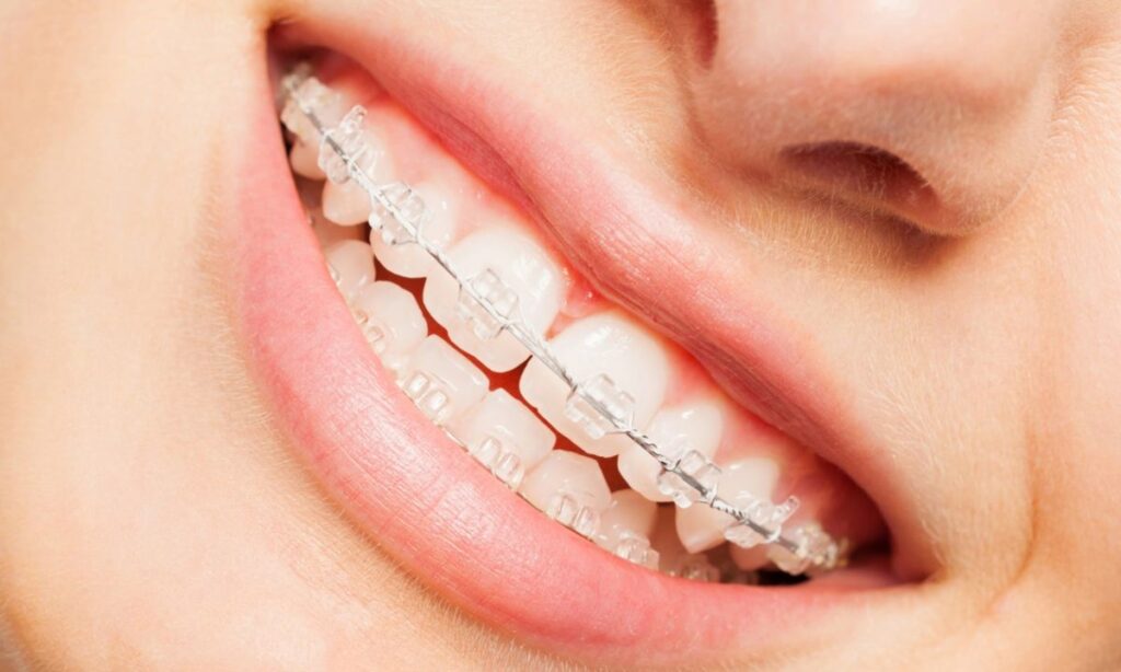 Can Malocclusion Be Fixed Without Braces? | Focus Dental