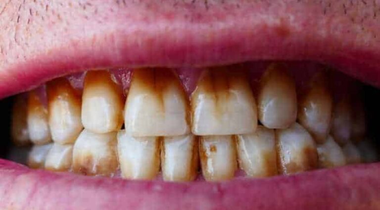 How do I get rid of gutka stains on my teeth? | Focus Dental